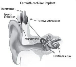 Understanding How Cochlear Implants Work