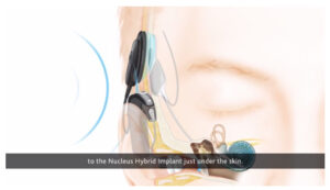 Transforming Hearing with Cochlear® Hybrid